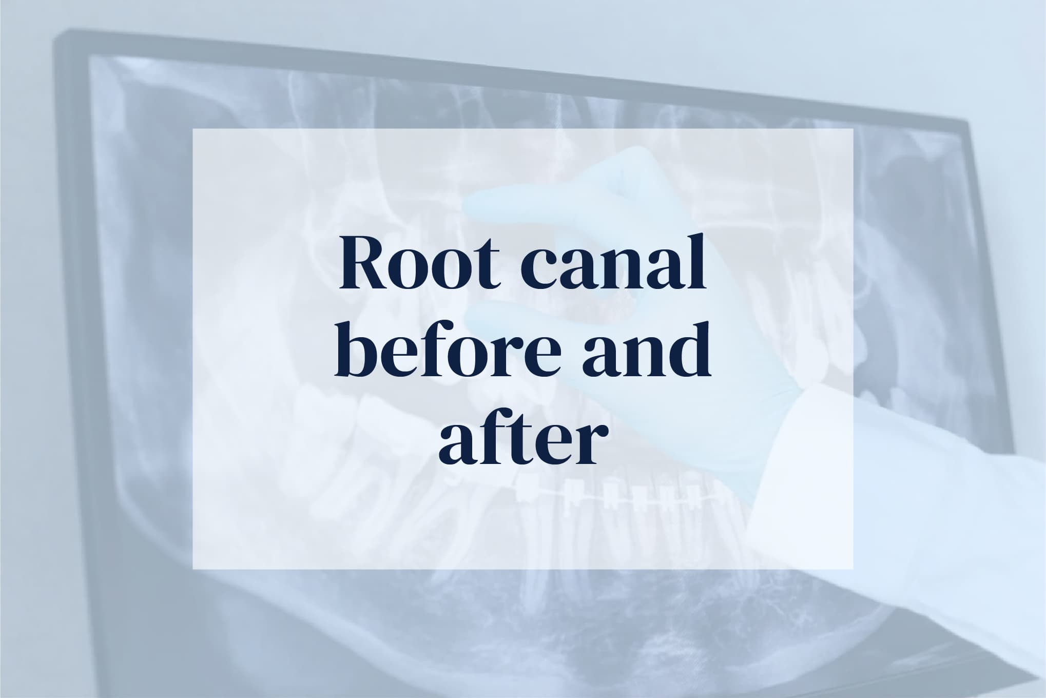 Trident Smiles Dental | Root canal before and after